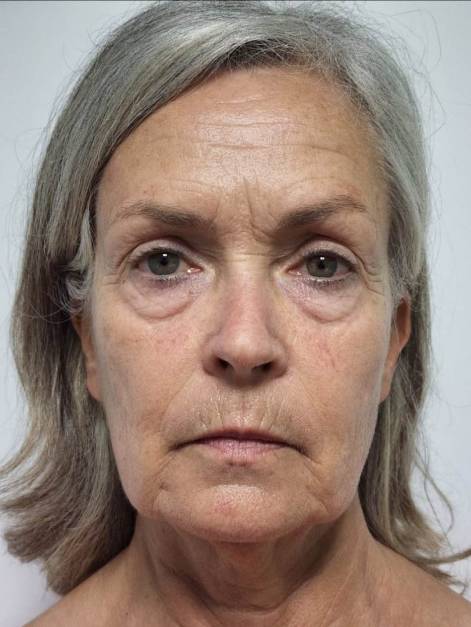 Facelift in Mexico - con el Dr Edgar Torres