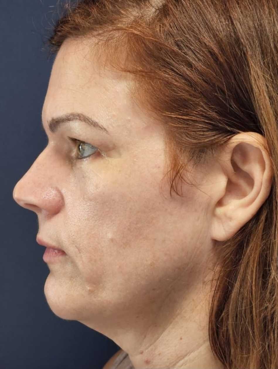 Facelift in Mexico - con el Dr Edgar Torres